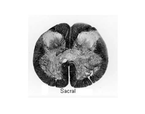 Sacral Spinal Level Quiz
