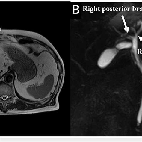 Magnetic Resonance Cholangiopancreatography Mrcp Detecting A Download Scientific Diagram