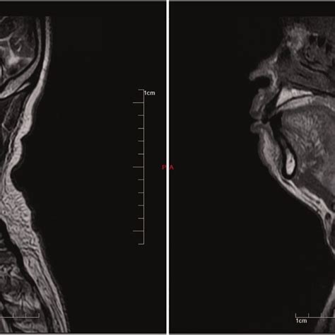 Magnetic Resonance Imaging Of A 70 Year Old Male That Presented With A