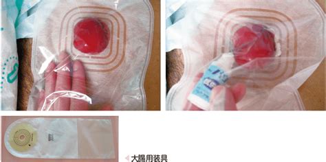 手術直後に使用する装具は特別なものが必要なの？｜ストーマ装具 看護roo カンゴルー