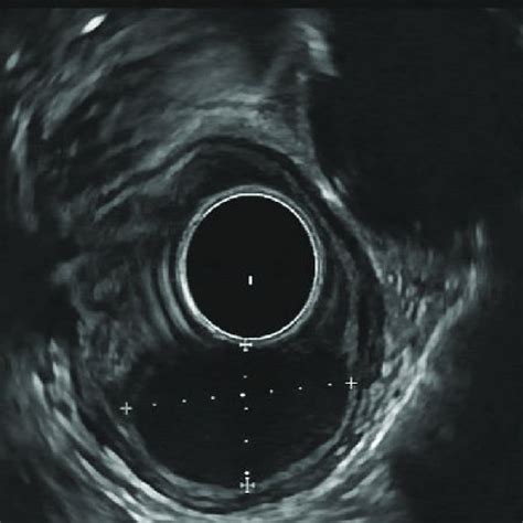 Endoscopic Submucosal Dissection For Esophageal Granular Cell Tumor
