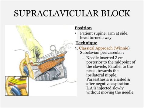 Brachial Plexus Blocks PPTX