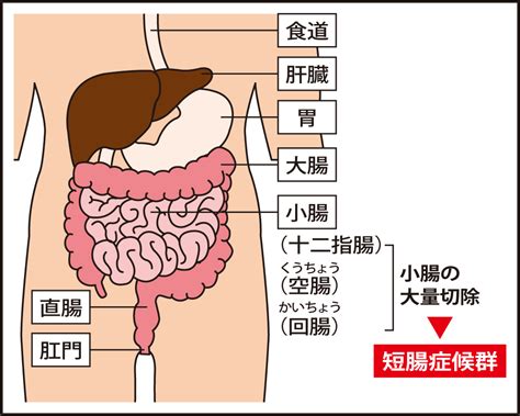 小腸の切除で成長に障害～子どもの短腸症候群（久留米大学病院 加治建教授）～｜医療ニュース トピックス｜時事メディカル｜時事通信の医療ニュースサイト