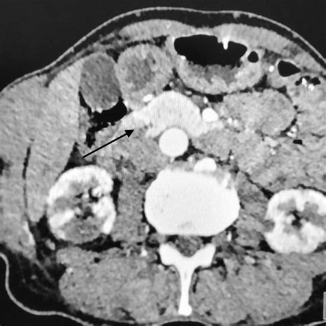Axial Contrast Enhanced Ct Image At The Level Of Renal Hilum Showing