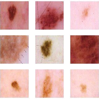 ISIC2020 Image 75 Crop Image 18 Download Scientific Diagram