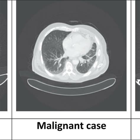 Sample Of Three Types Of Ct Scan Of Patients In Classification
