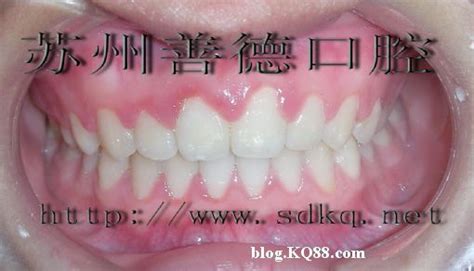 苏州门牙之间双多生牙的矫正（苏州口腔原创） 吴云的博客 Kq88口腔博客