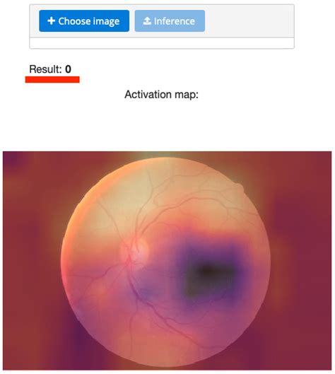 Detecting Eye Disease Using Ai Kaggle Bronze Place By Huseyn