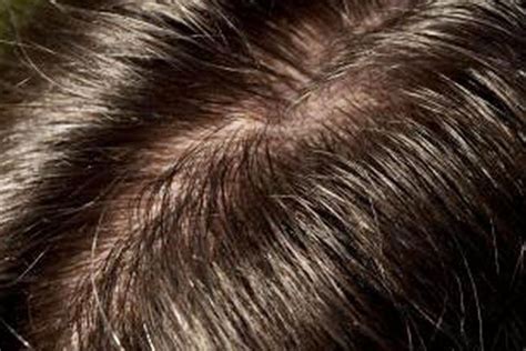 How To Get Rid Of Dry Scalp