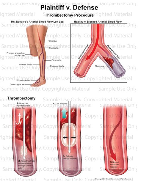Thrombectomy Procedure Motionlit