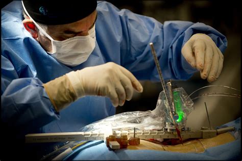 The Mazor Robotics System Is 5x Better Than Fluoroscopic Guided And