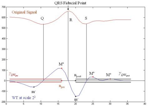 Detection Of Qrs Individual Waves And The Qrs Morphology It Shows A
