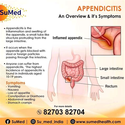 Sumed Healthcare On Linkedin Appendicitis Appendix Symptoms Overview Inflammation Swelling…