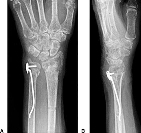 Distal Radius Fracture Pinning Technique At Vincent Benton Blog