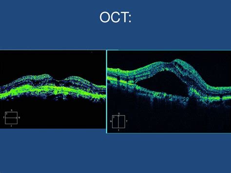 Ppt Rpe Tear Powerpoint Presentation Free Download Id 11697131