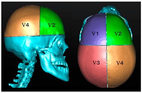 Cranial Vault Deformation And Its Association With Mandibular Deviation