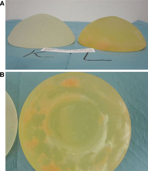 Soft Brown Rupture Clinical Signs And Symptoms Associated With