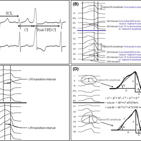 Eletrocardiographic ECG Parameters A CI And PostVPD CI B QR And