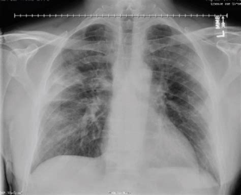 03262020 Unresolved Patchy Opacities In The Periphery Of Both Lungs