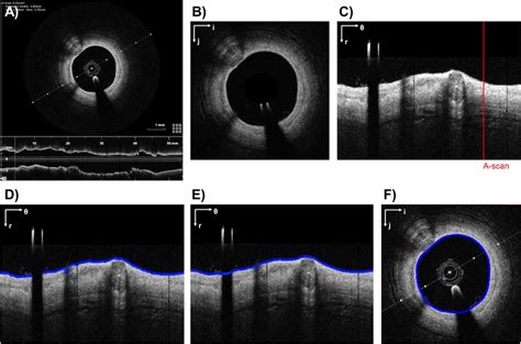 example of lumen detection algorithm a original grayscale oct image b