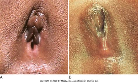 Genitourinary Dysfunction Pediatric Exam IV Flashcards Quizlet