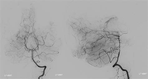 Choroid Plexus Papilloma Preoperative Embolization Choroid Plexus Papilloma Preoperative Embolization