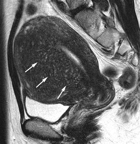 Mr Imaging Findings Of Adenomyosis Correlation With Histopathologic