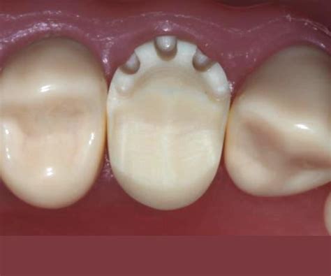 Indirect Restorations Metal Ceramic Pfm Crown Prep Upper 1st Premolar