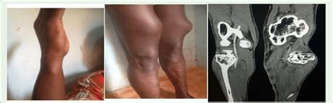 Bone Swelling In The Distal Third Of The Right Forearm And Distal Third