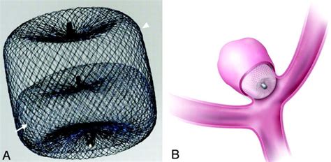 Intrasaccular Flow Disruption Treatment Of Intracranial Aneurysms Preliminary Results Of A