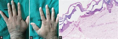 Isolated Aquagenic Acrokeratoderma Of Dorsal Hands Pmc