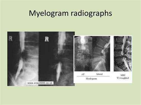Ppt Myelography And Cns Exams Using Mri And Ct Powerpoint Presentation Id 240432