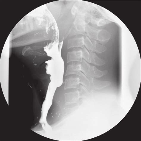 The Reconstructed Cervical Oesophagus With The Free Radial Forearm Flap