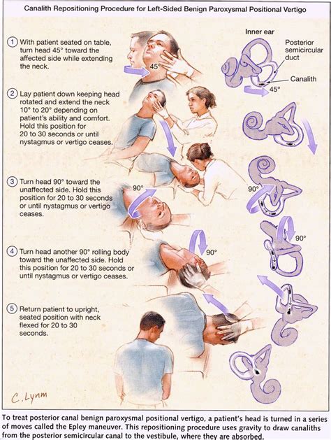 Directions For The Epley Maneuver For Vertigo Frosdlynx