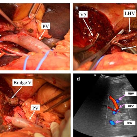 Intraoperative Hepatic Vascular Management A Skeletonization Of Right
