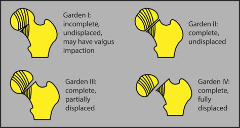 Garden Hip Classification Garden Classification Of Femur Neck