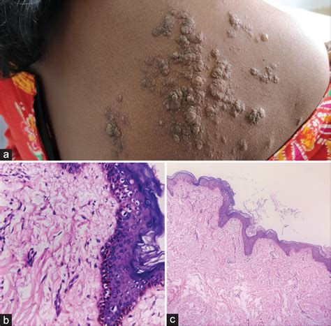 Nevus Lipomatosus Cutaneous Superficialis An Odd Site Karnataka