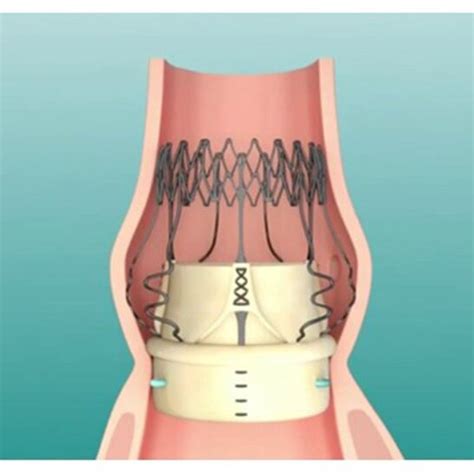 Proposed Algorithm For The Work Up Of Severe Aortic Stenosis The