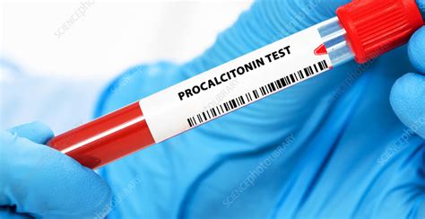 Procalcitonin Test Stock Image F044 9604 Science Photo Library