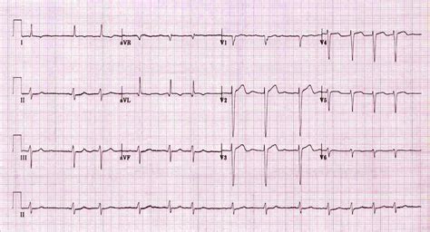Dilt V Metoprolol In Afibrvr