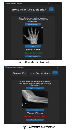 Classification Of Bone Fractures Using Cnn