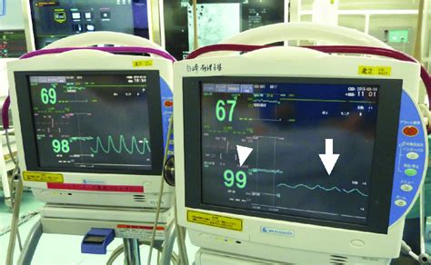 Pulse Oximeter Waveform Pulse Oximetry Waveforms After A Temporary Download Scientific Diagram