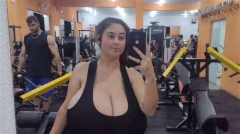 Jovem Retira 10kg De Mama Após Diagnóstico De Doença Rara