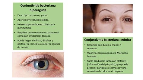 Conjuntivitis Bacterianapptx Descarga Gratuita