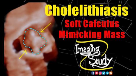 Cholelithiasis Soft Calculus Mimicking Mass Ultrasound Case 317 Youtube