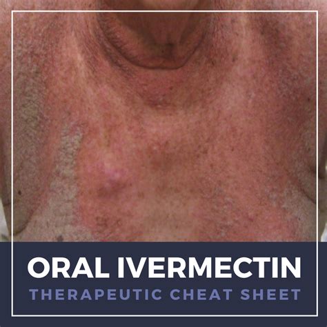 Blepharitis Archives Next Steps In Dermatology