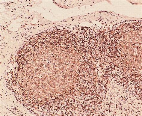 Pathology Outlines Bcl2