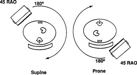 Figure 1 From Prone Versus Supine Thallium Myocardial Spect A Method To Decrease Artifactual