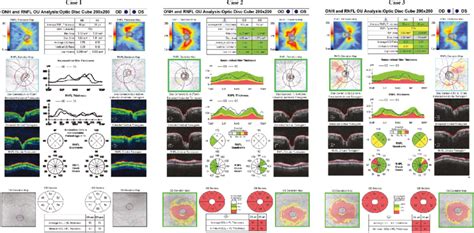 Cirrus Optical Coherent Tomography Oct For Case 1 Left 2 Middle Download Scientific