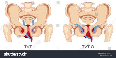 Set Urinary Incontinence Tension Free Vaginal Stock Vector Royalty Free Shutterstock